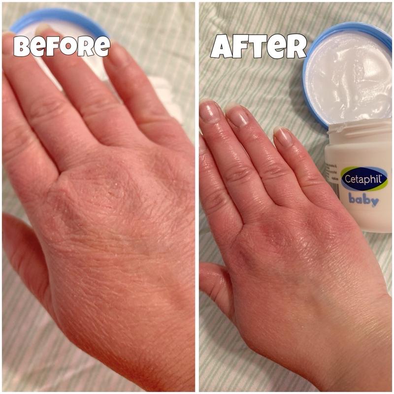 Cetaphil for eczema baby store