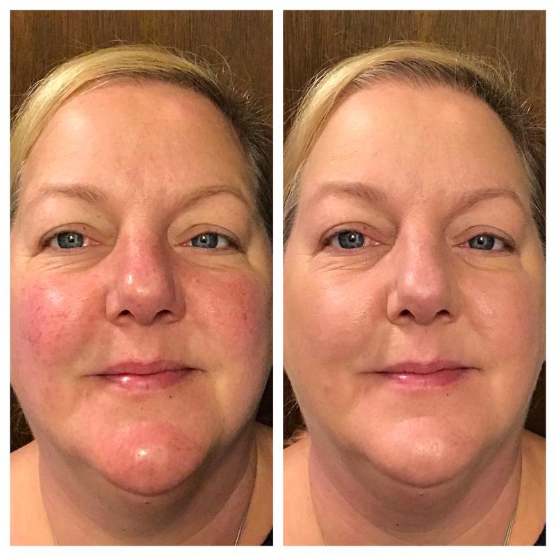 Mineral Powder Makeup Rosacea | Saubhaya Makeup