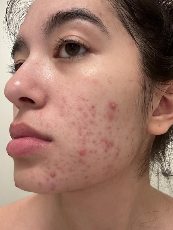 The Acne Set The Ordinary