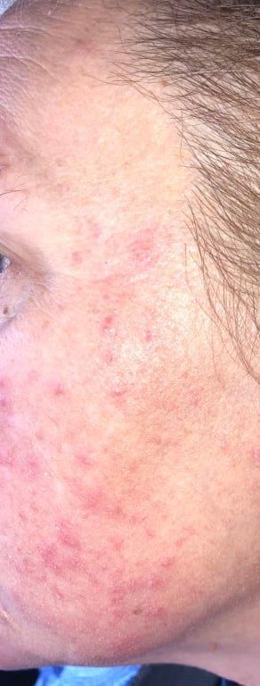 Malassezia On Face | lupon.gov.ph