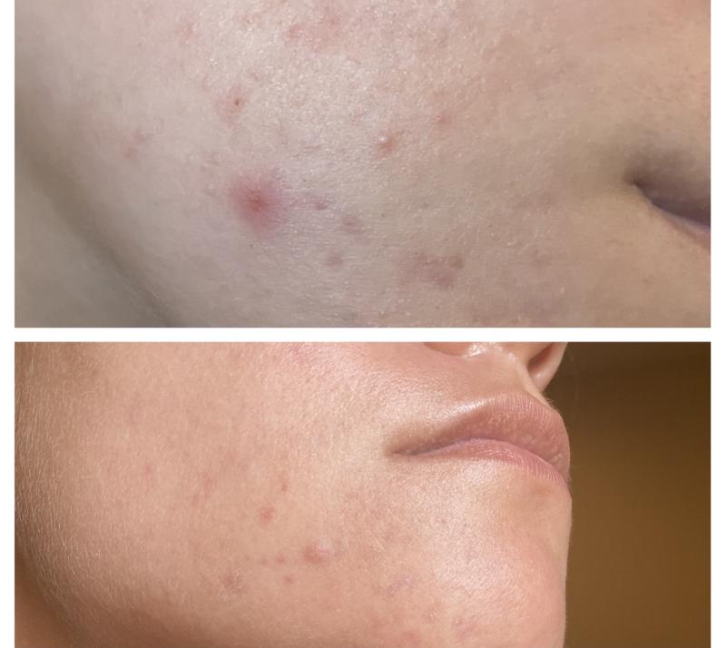 Rapid Clear Acne Treatment With Benzoyl Peroxide