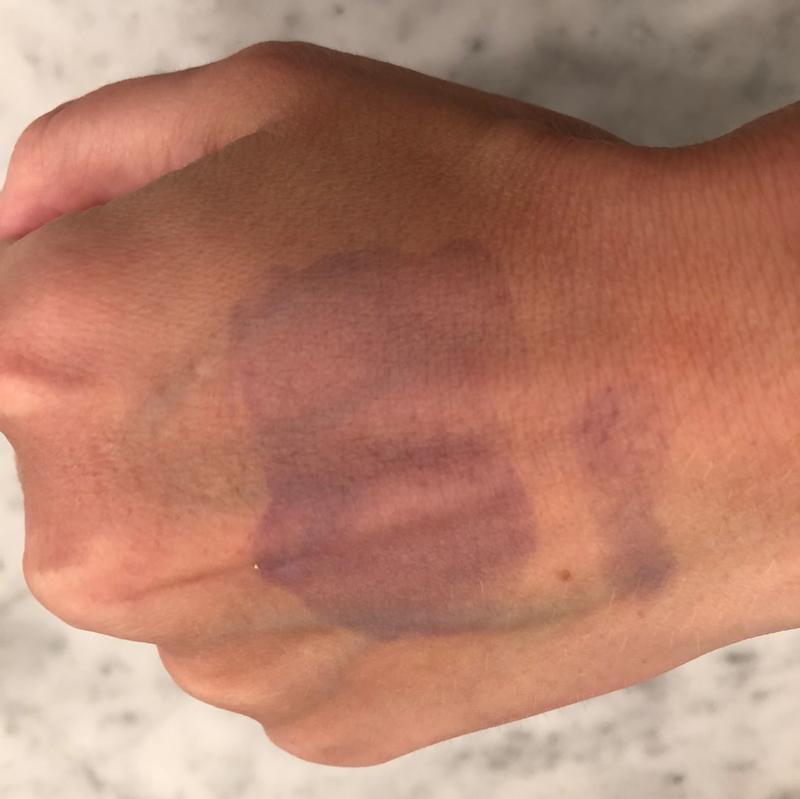 Bruised Knuckles From Punching A Wall